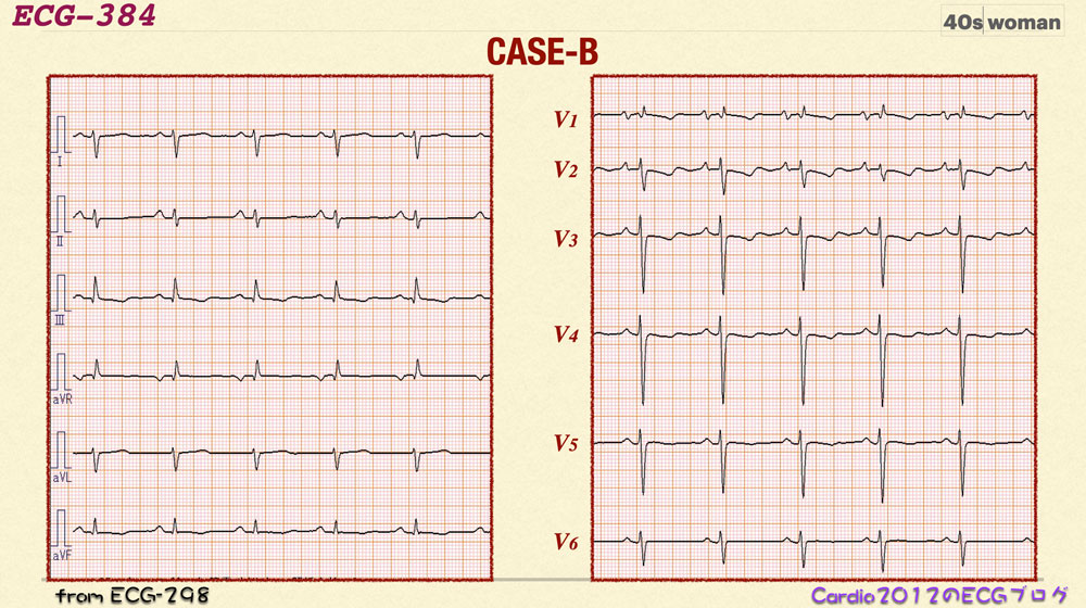 ECG-384： #心電図検定試験-Question-9 肺高血圧症でないのは、どれでしょう。 - Cardio2012のECGブログ-2019改