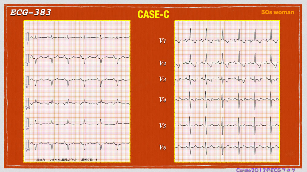 ECG-384： #心電図検定試験-Question-9 肺高血圧症でないのは、どれでしょう。 - Cardio2012のECGブログ-2019改