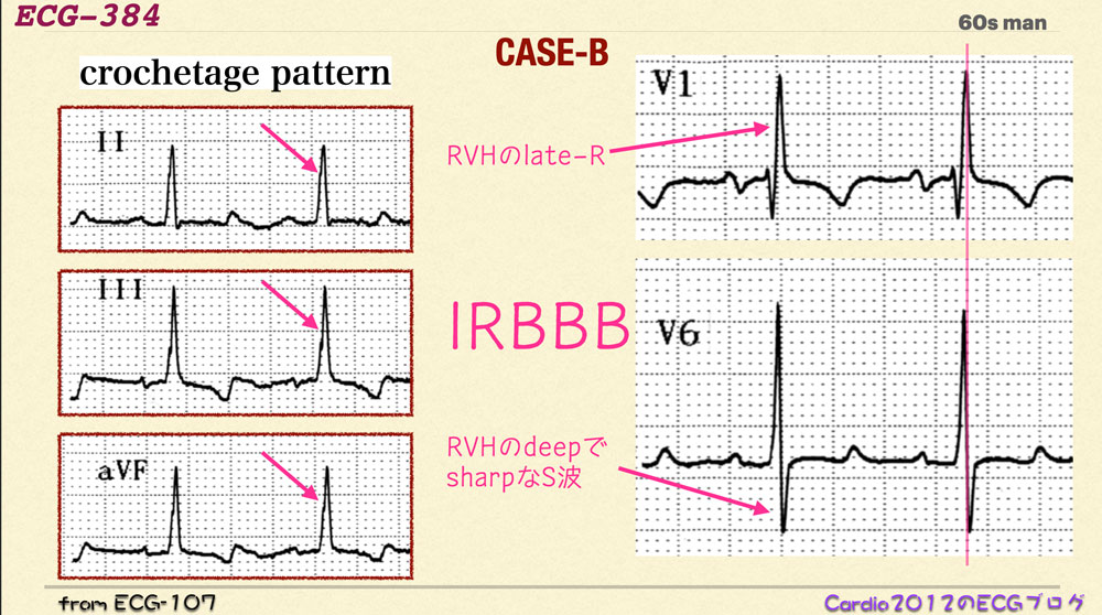 ECG-384： answer(1/2) #心電図検定試験-Question-9 肺高血圧症でないのは、どれでしょう ...