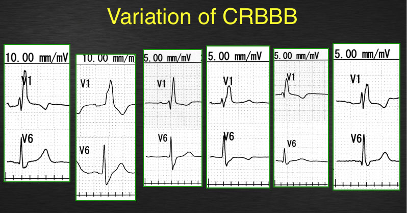 ECG-034：answer - Cardio2012のECGブログ-2019改