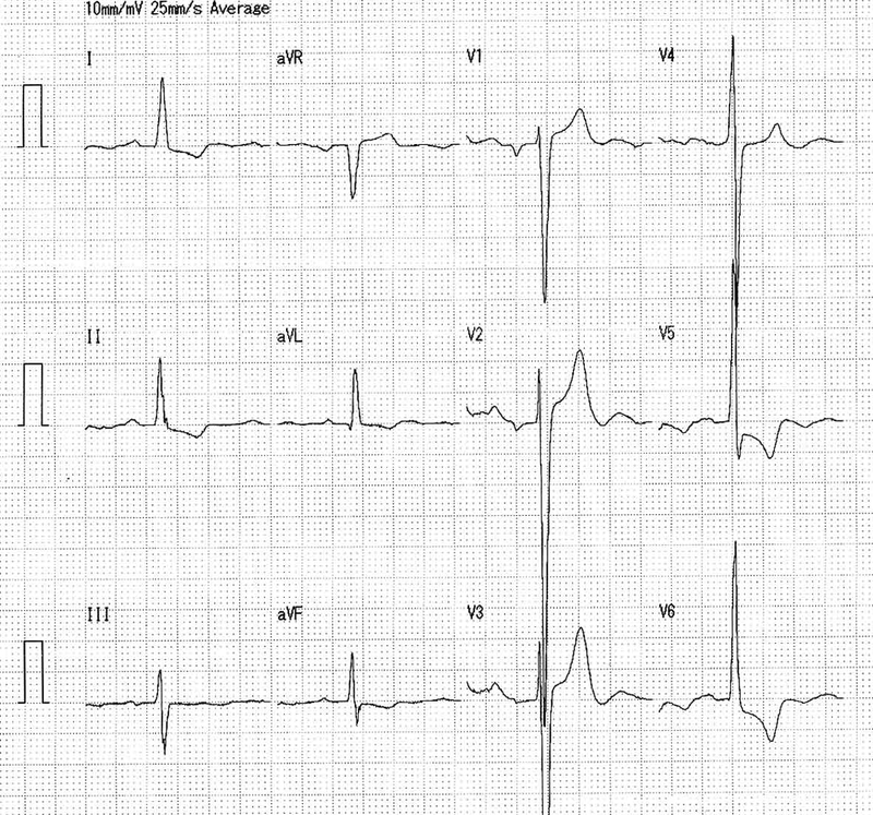 ECG-048：82才男性。慢性心不全。Erb領域 LEV IV ESM - Cardio2012のECGブログ-2019改