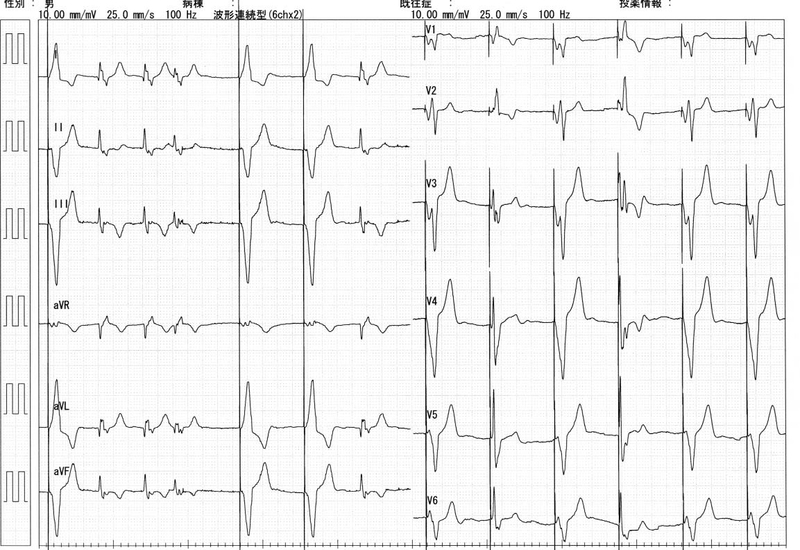 ECG-068：76才男性。VVI-PaceMakerの作動について - Cardio2012のECGブログ-2019改