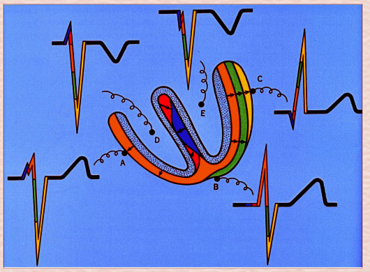 【コラム】CLBBB時には、左心機能はどうなるのでしょうか。 - Cardio2012のECGブログ-2019改