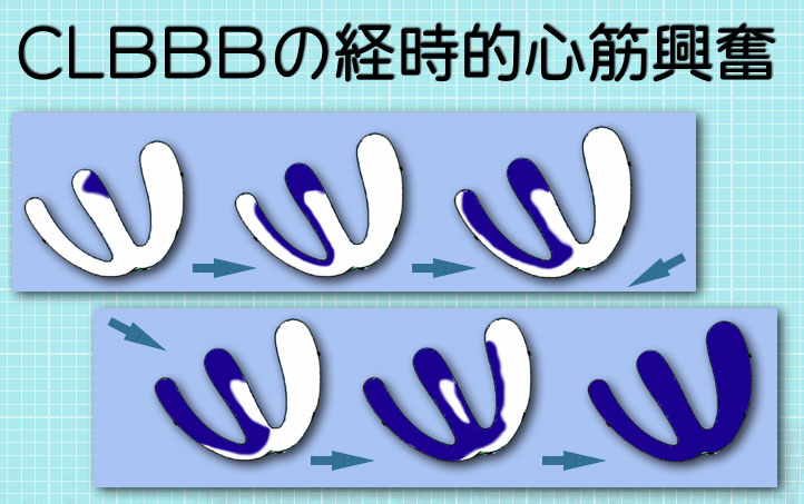 【コラム】CLBBB時には、左心機能はどうなるのでしょうか。 - Cardio2012のECGブログ-2019改