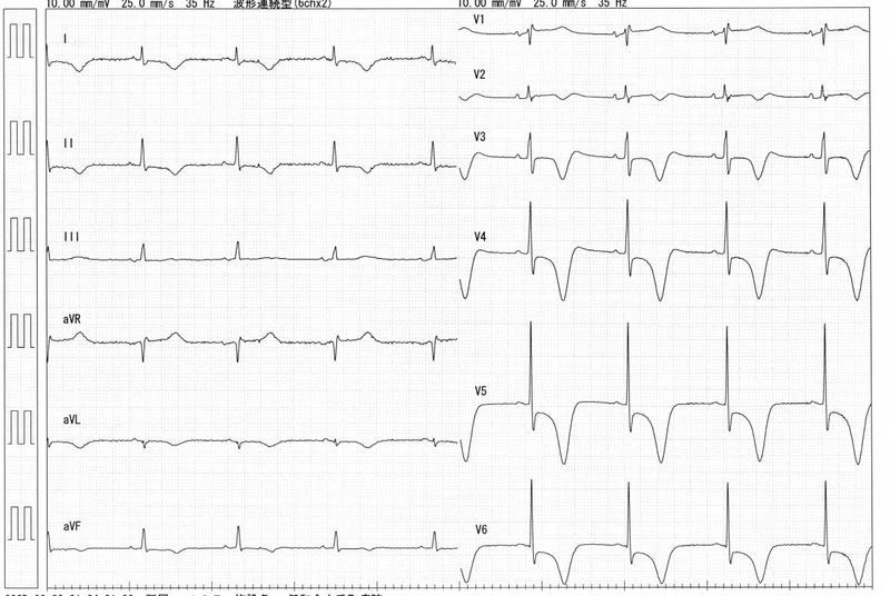 ECG-106：105の症例が、呼吸不全を起こしました。 - Cardio2012のECGブログ-2019改