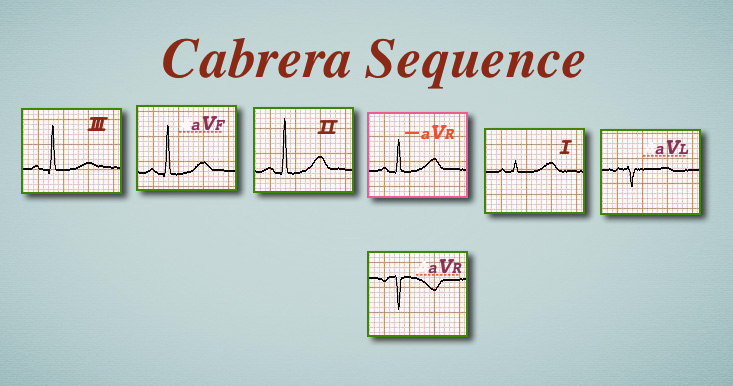 【コラム-021】正常心電図05＝(18誘導+1 & Cabrera誘導)：43才女性。 - Cardio2012のECGブログ-2019改