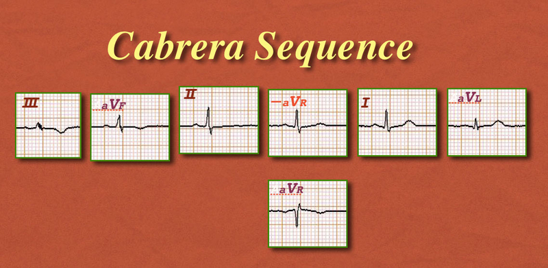 【コラム-022】正常心電図06＝(18誘導+1 & Cabrera誘導)：25才女性。 - Cardio2012のECGブログ-2019改