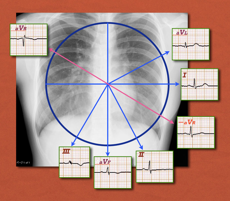 【コラム-022】正常心電図06＝(18誘導+1 & Cabrera誘導)：25才女性。 - Cardio2012のECGブログ-2019改