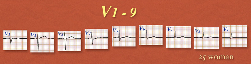【コラム-022】正常心電図06＝(18誘導+1 & Cabrera誘導)：25才女性。 - Cardio2012のECGブログ-2019改