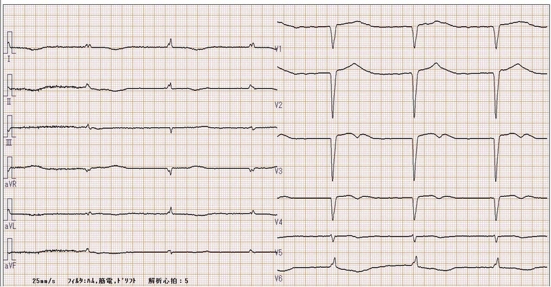 ECG 127 answer Cardio2012 ECG 2019 ecg-127-answer-cardio2012-ecg-2019