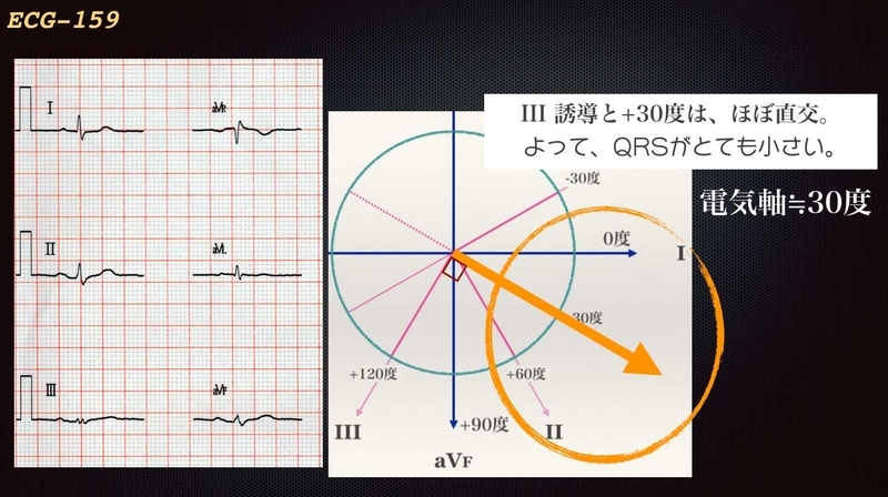 ECG-159：answer - Cardio2012のECGブログ-2019改
