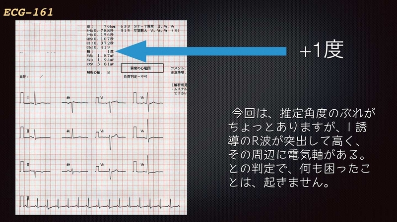 ECG-161：answer - Cardio2012のECGブログ-2019改