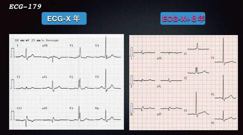 ECG-179：81才男性。8年間の心電図と胸部レントゲン変化です。 - Cardio2012のECGブログ-2019改