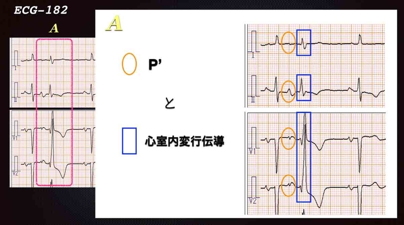 ECG-182：answer - Cardio2012のECGブログ-2019改