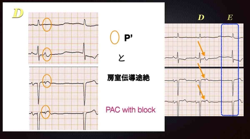 ECG-182：answer - Cardio2012のECGブログ-2019改