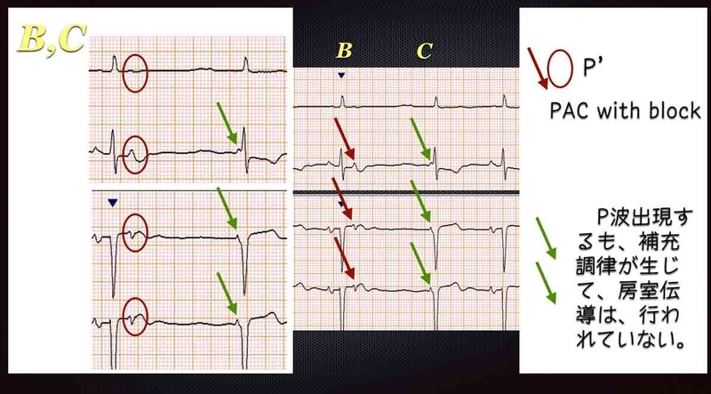 ECG-182：answer - Cardio2012のECGブログ-2019改