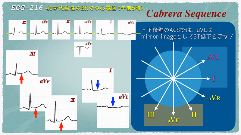 ECG-216：answer(1/2) - Cardio2012のECGブログ-2019改