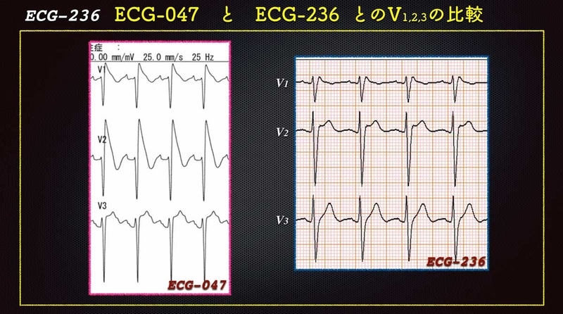 ECG-236：answer(1/2) - Cardio2012のECGブログ-2019改