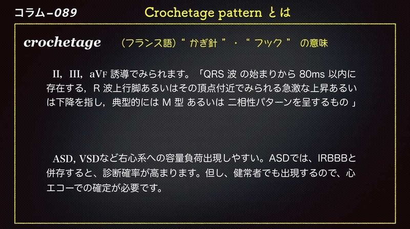 コラム-089 ：Crochetage patternって、何ですか？ - Cardio2012のECGブログ-2019改
