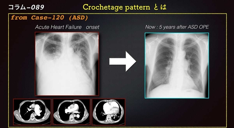 コラム-089 ：Crochetage patternって、何ですか？ - Cardio2012のECGブログ-2019改