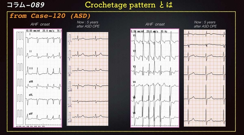 コラム-089 ：Crochetage patternって、何ですか？ - Cardio2012のECGブログ-2019改