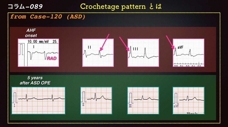 コラム-089 ：Crochetage patternって、何ですか？ - Cardio2012のECGブログ-2019改