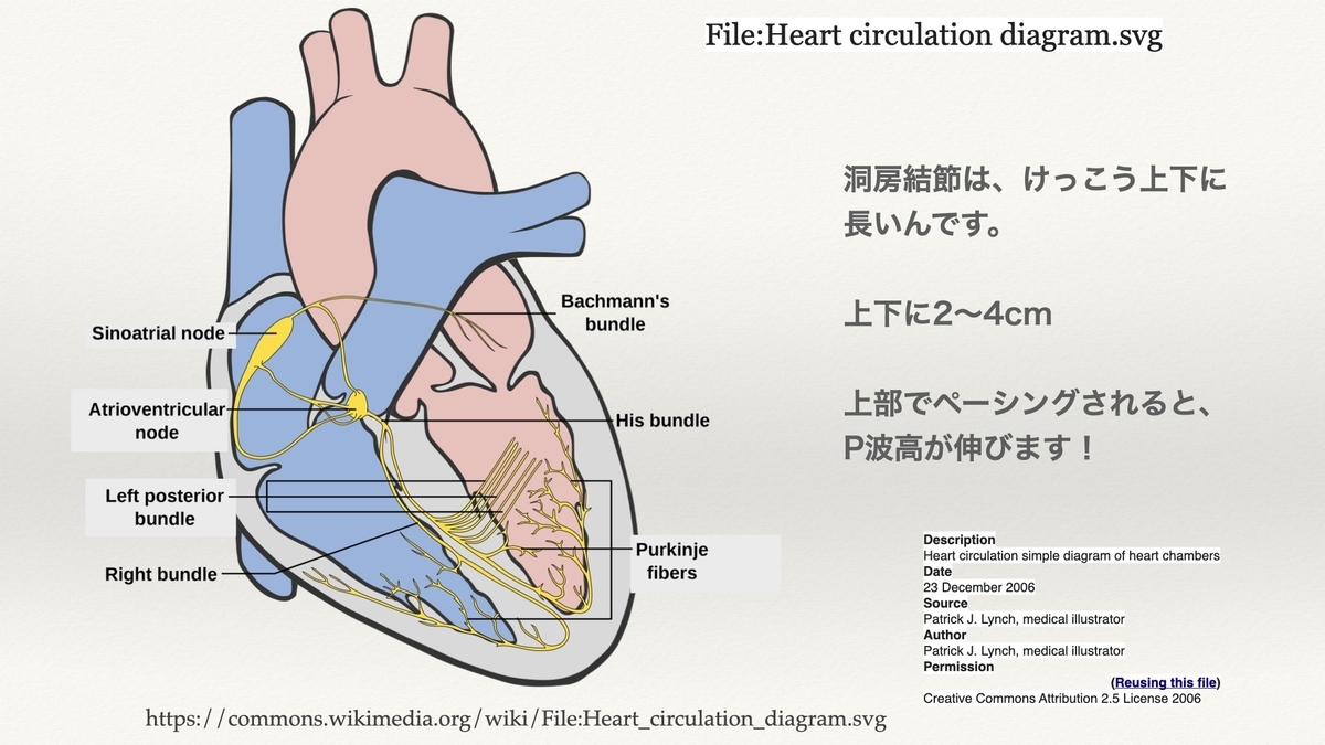 コラム：Sino-atrial exit block Wenckebach type SA block(Mobitz-I型)。 = 心電図検定 ...