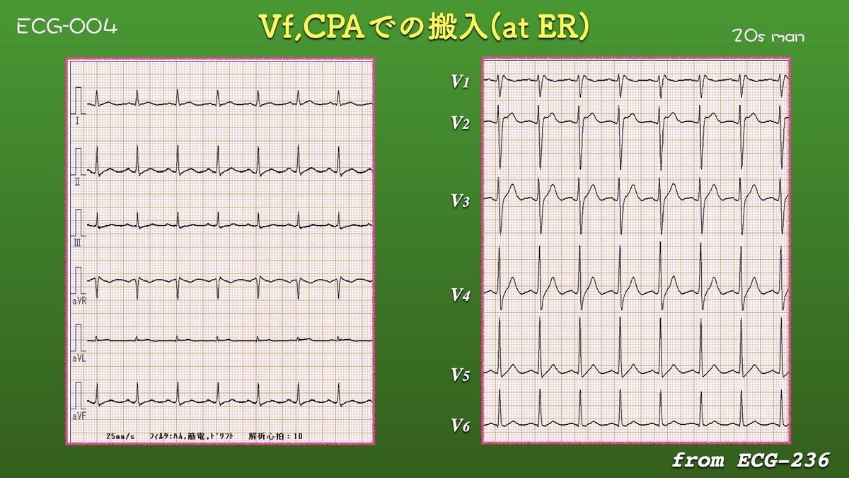 【コラム-119】サーベイ2021へのオマージュ(ECG-4)：失神・CPAとBrugada syndrome の波形 ...