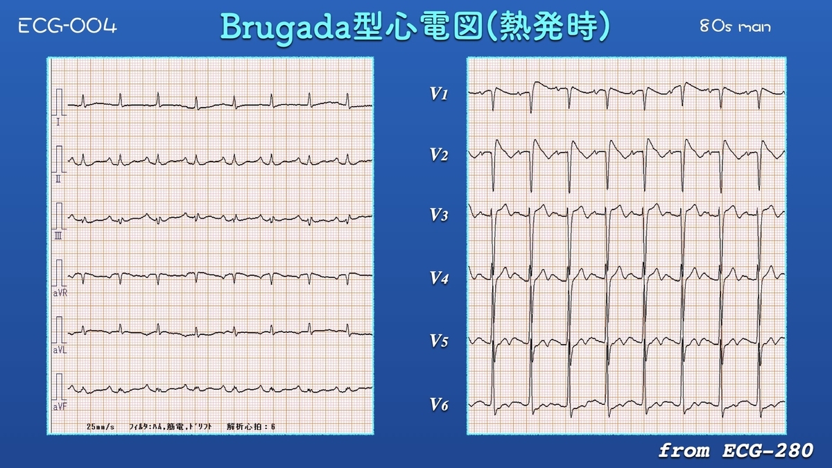 【コラム-119】サーベイ2021へのオマージュ(ECG-4)：失神・CPAとBrugada syndrome の波形 ...