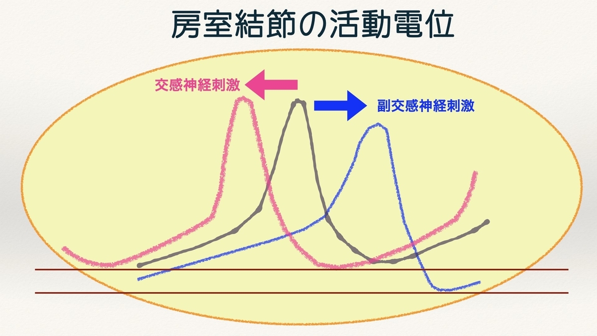 【コラム-134】：心電図検定試験-2A合格から1B合格までシリーズ 002：Wenckebach AV block(その2 ...