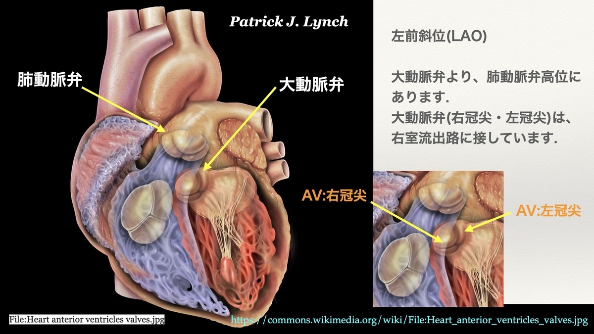 【コラム-142】そのPVCはどこから？ 01 - 基礎編とRVCT-PVC 2023/2/9の講演会 予習編です。 - Cardio2012 ...