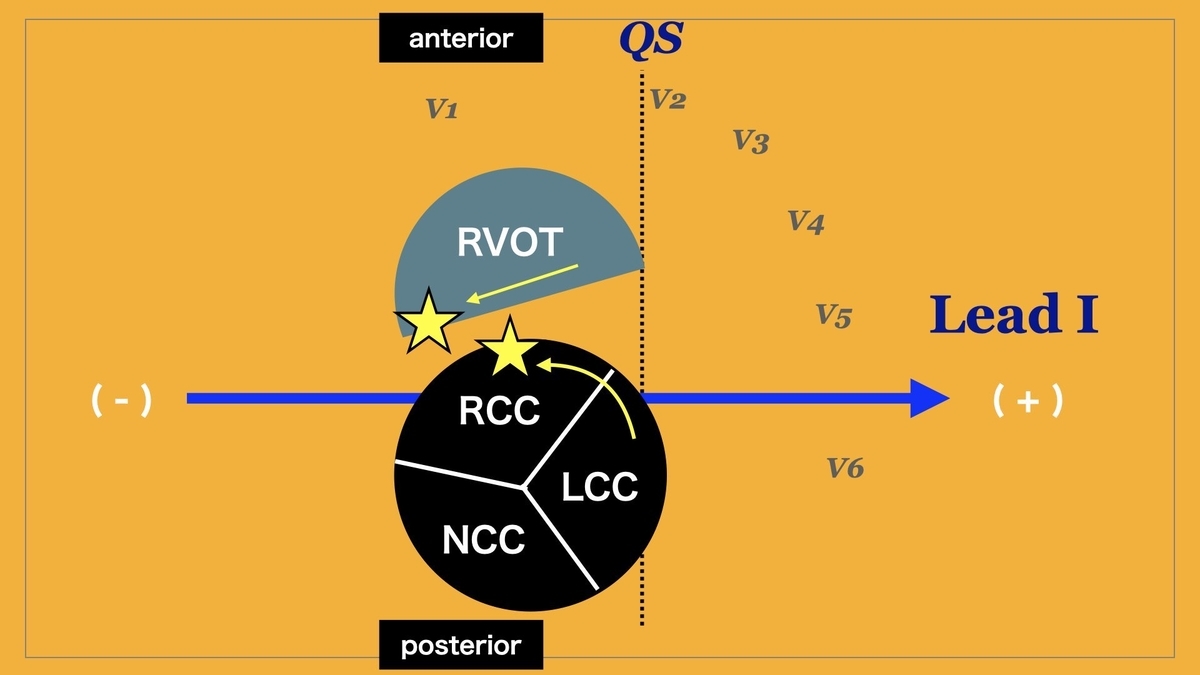 【コラム-142】そのPVCはどこから？ 02 - LVOT-PVC 2023/2/9の講演会 予習編です。 - Cardio2012のECG ...