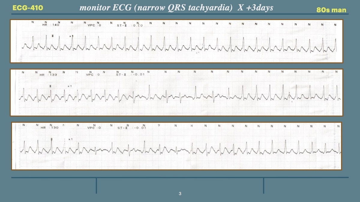 【ECG-410】80s man： 不安定な narrow QRS tachycardia - Cardio2012のECGブログ-2019改