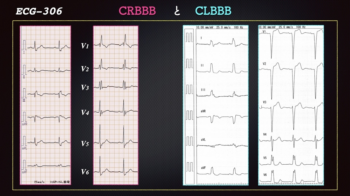 【コラム-143】CRBBBの本質-あしたのために その1 #心電図検定試験2023 - Cardio2012のECGブログ-2019改