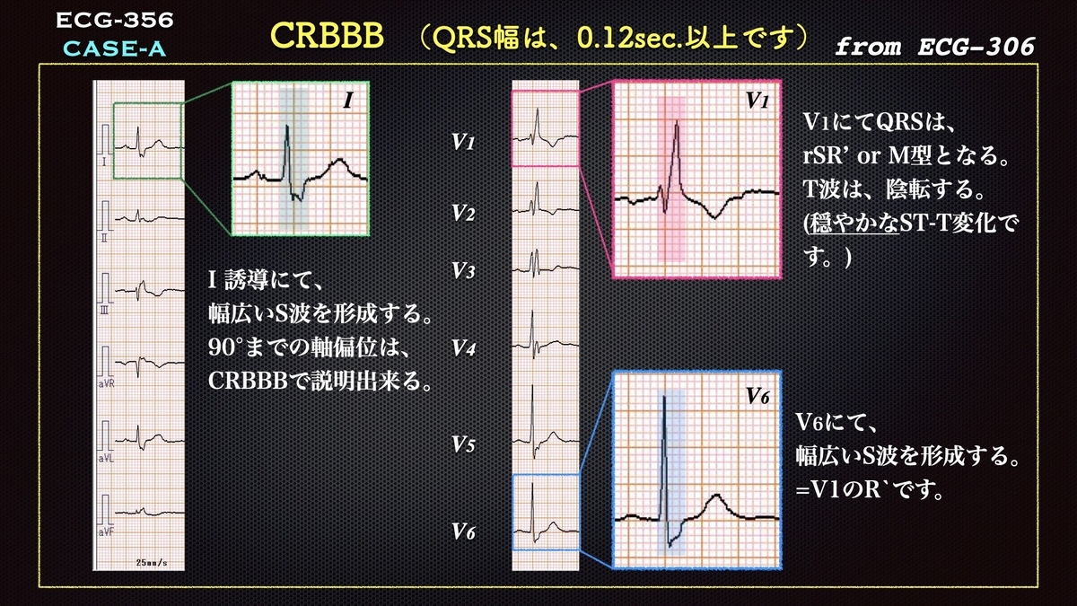 【コラム-143】CRBBBの本質-あしたのために その1 #心電図検定試験2023 - Cardio2012のECGブログ-2019改