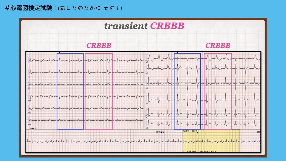 【コラム-145】あしたのために その1 ：CRBBBの本質 #心電図検定試験2023 の改訂版です💦 - Cardio2012のECGブログ ...