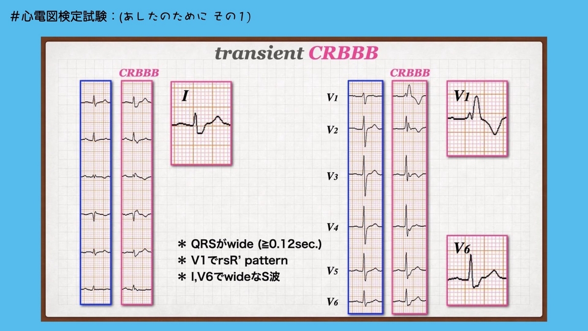 【コラム-145】あしたのために その1 ：CRBBBの本質 #心電図検定試験2023 の改訂版です💦 - Cardio2012のECGブログ ...