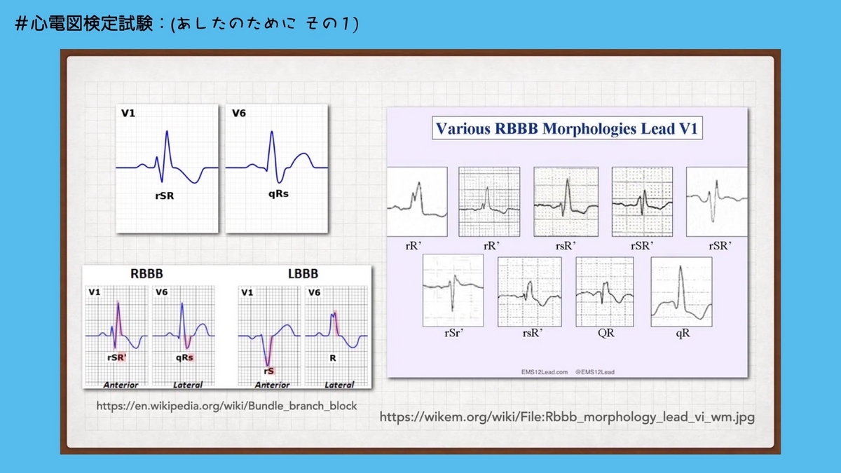 【コラム-145】あしたのために その1 ：CRBBBの本質 #心電図検定試験2023 の改訂版です💦 - Cardio2012のECGブログ ...