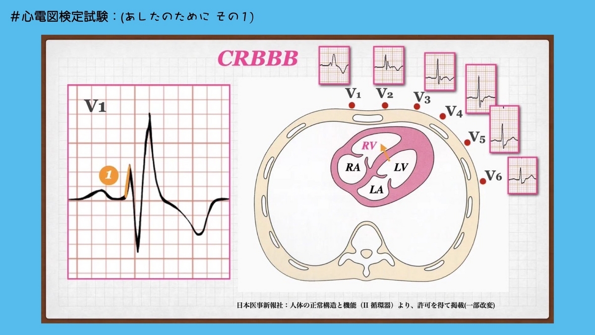 【コラム-145】あしたのために その1 ：CRBBBの本質 #心電図検定試験2023 の改訂版です💦 - Cardio2012のECGブログ ...