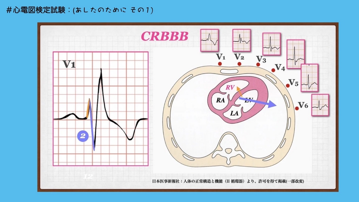 【コラム-145】あしたのために その1 ：CRBBBの本質 #心電図検定試験2023 の改訂版です💦 - Cardio2012のECGブログ ...