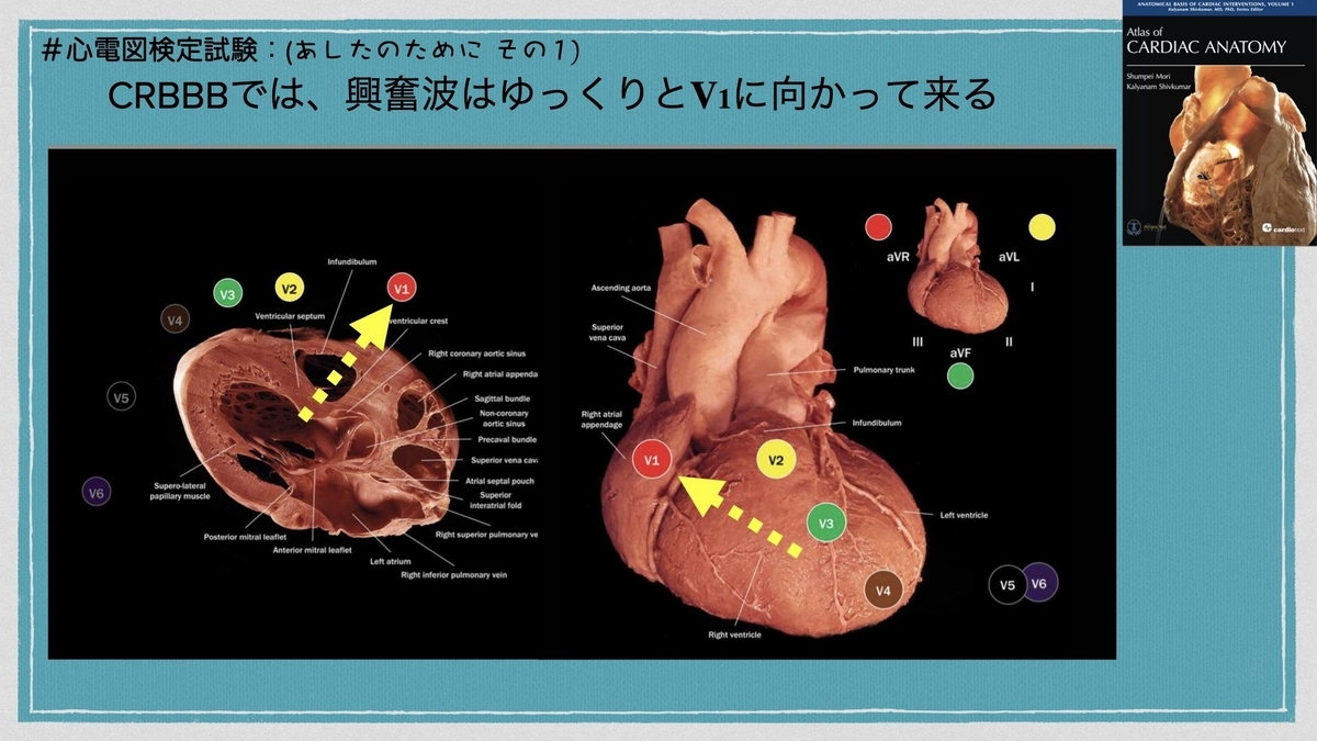 【コラム-145】あしたのために その1 ：CRBBBの本質 #心電図検定試験2023 の改訂版です💦 - Cardio2012のECGブログ ...