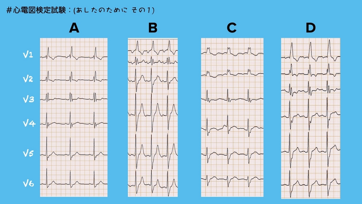 【コラム-145】あしたのために その1 ：CRBBBの本質 #心電図検定試験2023 の改訂版です💦 - Cardio2012のECGブログ ...