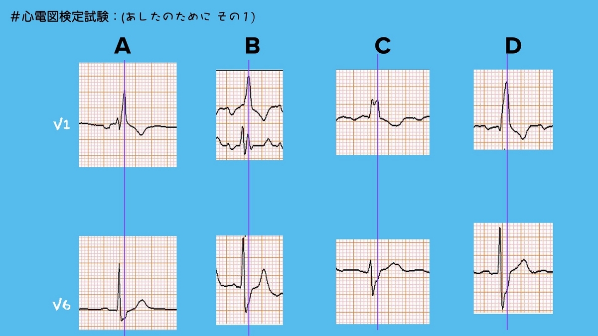 【コラム-145】あしたのために その1 ：CRBBBの本質 #心電図検定試験2023 の改訂版です💦 - Cardio2012のECGブログ ...