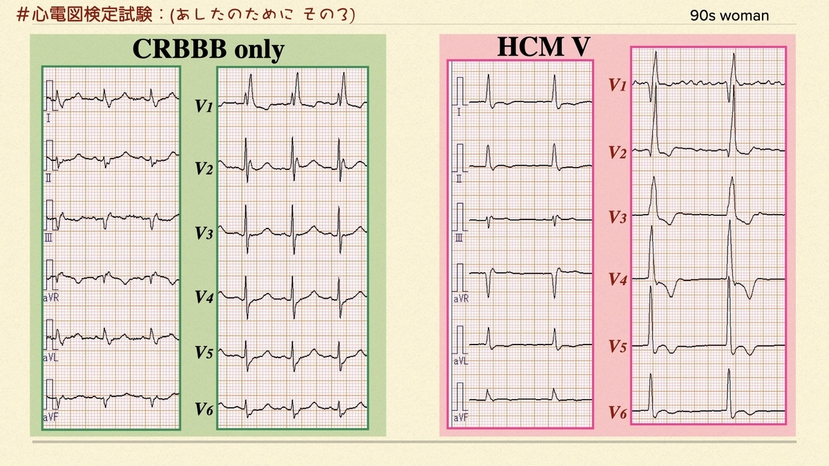 【コラム-147：変なCRBBB-あしたのために HCM編 その3】 - Cardio2012のECGブログ-2019改