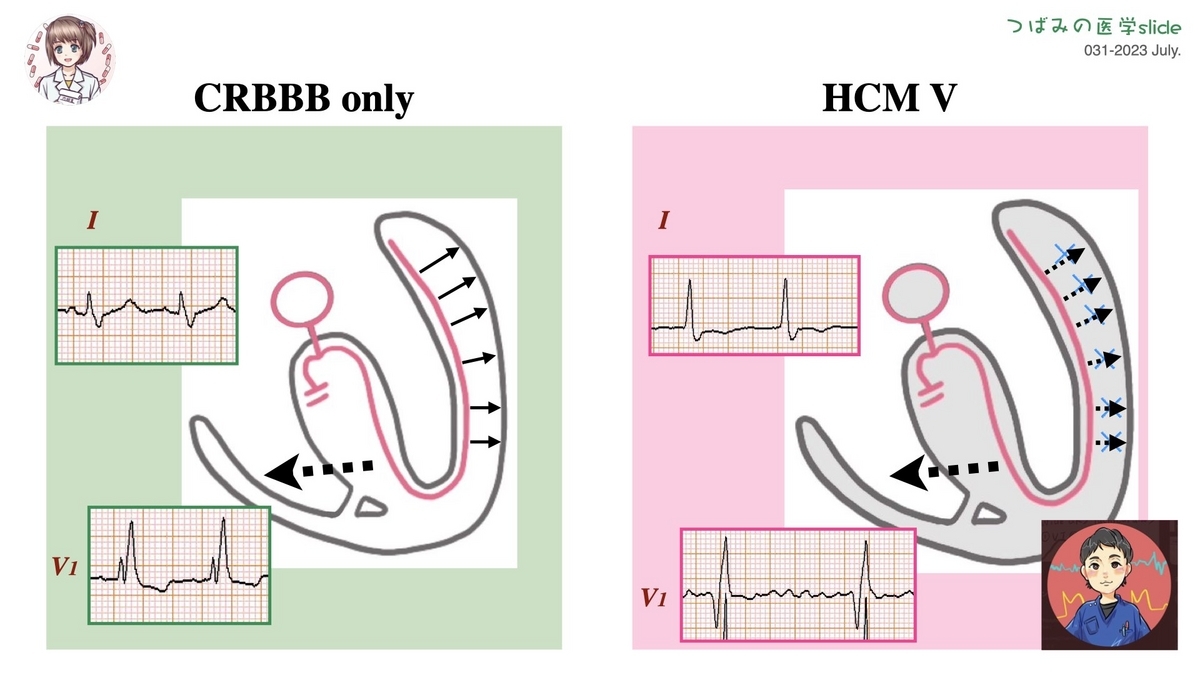 【コラム-147：変なCRBBB-あしたのために HCM編 その3】 - Cardio2012のECGブログ-2019改