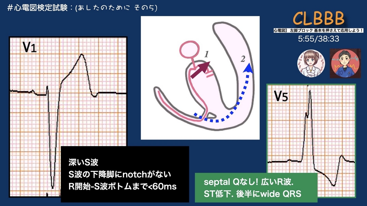 【コラム-148：あしたのために その5-CLBBB】 - Cardio2012のECGブログ-2019改