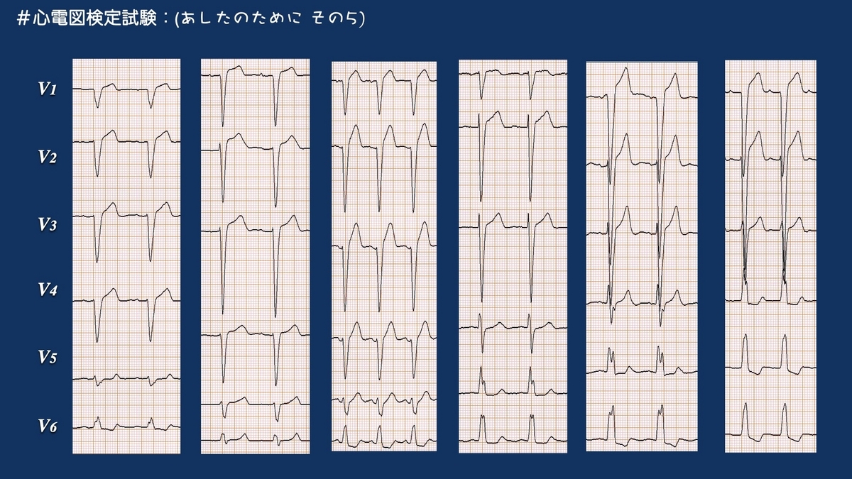 【コラム-148：あしたのために その5-CLBBB】 - Cardio2012のECGブログ-2019改