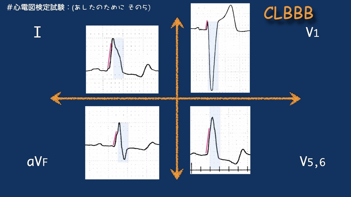 【コラム-148：あしたのために その5-CLBBB】 - Cardio2012のECGブログ-2019改