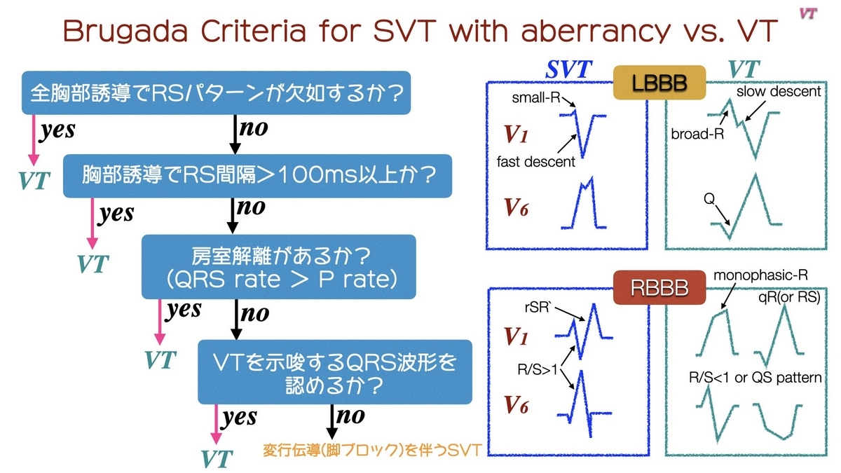 【コラム-151 前編：あしたのために その8-SVT vs VT】 - Cardio2012のECGブログ-2019改