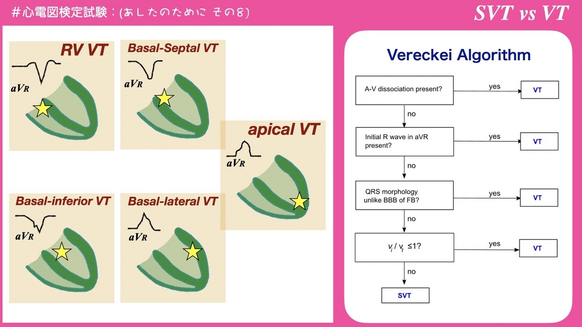 【コラム-151 前編：あしたのために その8-SVT vs VT】 - Cardio2012のECGブログ-2019改